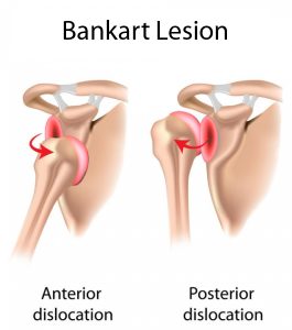 Bankart Lesion Bangalore | Shoulder Pain Symptoms