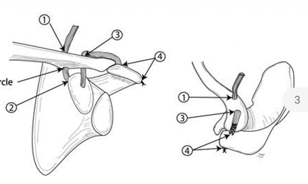 Shoulder Pain Treatment in Bangalore | AC Joint Separation