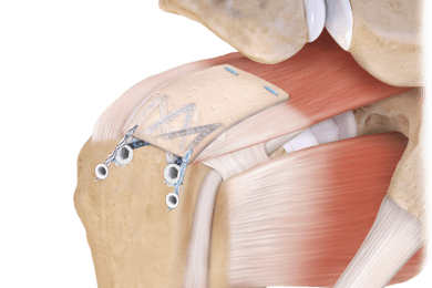 What is a SpeedBridge rotator cuff repair? | Repair of Rotator Cuff ...