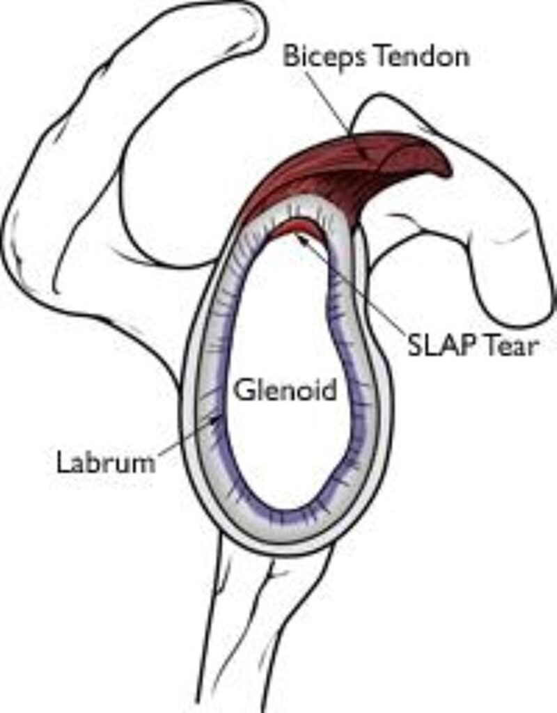 SLAP Tear and Posterior Labral Tear | Bangalore Shoulder Institute