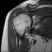 Subcoracoid impingement with subscapularis tendinosis